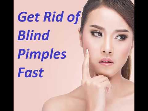 How to Get Rid of a Blind Pimple on Face and Skin | Remove Blind Pimple ...