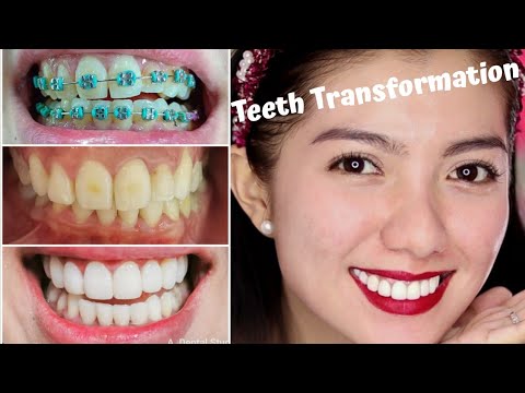 My Teeth Transformation + Veneers Experience + Gum Contouring and Teeth ...