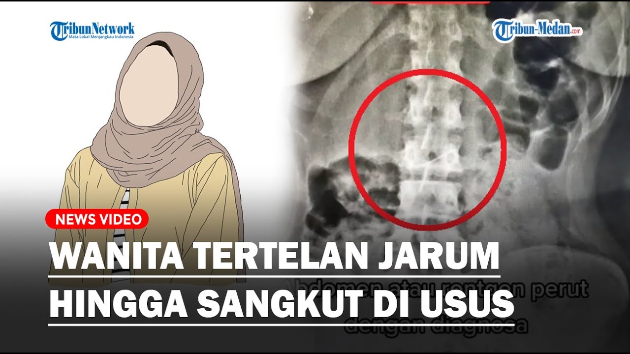 Viral Seorang Wanita Tertelan Jarum Pentul, Dokter Jelaskan Kondisinya ...