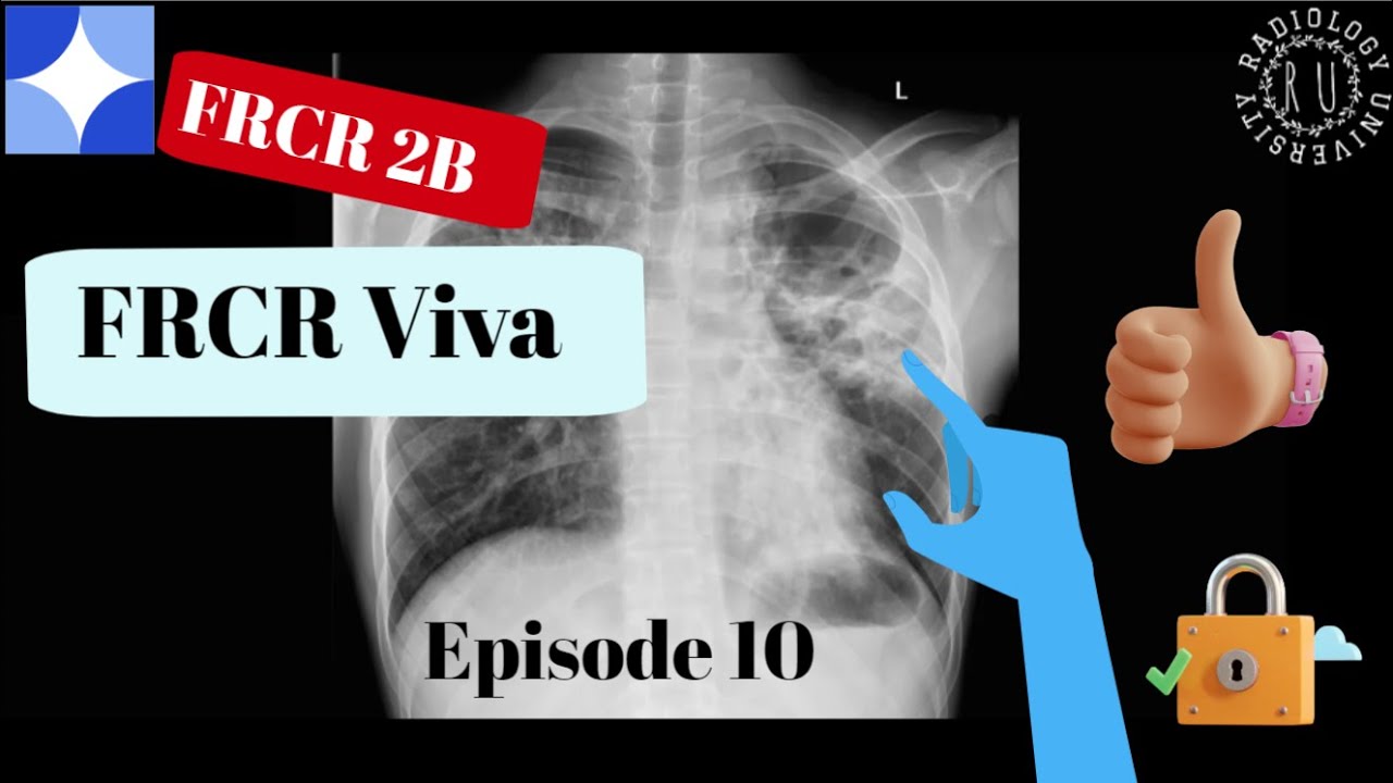 Episode 10: FRCR 2B viva experience part 5, Chest and Neuro Case - YouTube