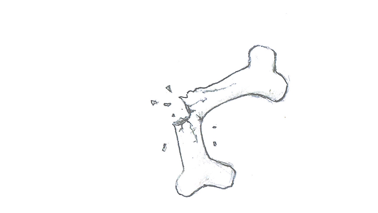 骨折音 大げさにボキッ！！！ 効果音 Exaggerated Broken Bone Sound Effect - YouTube