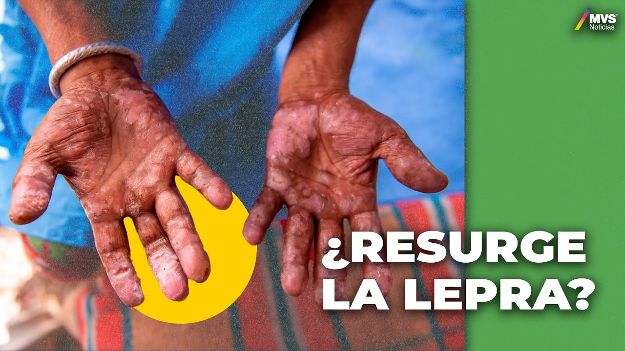 LEPRA EN MÉXICO: ¿Crisis SILENCIOSA o ALARMA Infundada? - YouTube