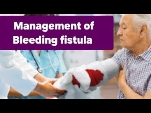 Management of AV fistula hemorrhage or (dialysis fistula) bleeding ...