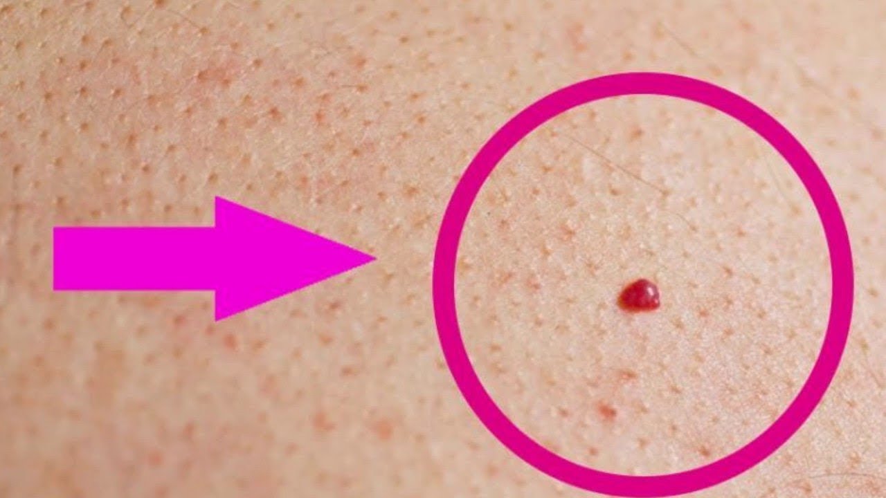 ¿Tienes estos puntos rojos en varias partes de su cuerpo? - YouTube