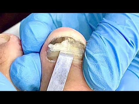 Scrape the toenails affected by fungi layer by layer【DT Pedicure】 - YouTube