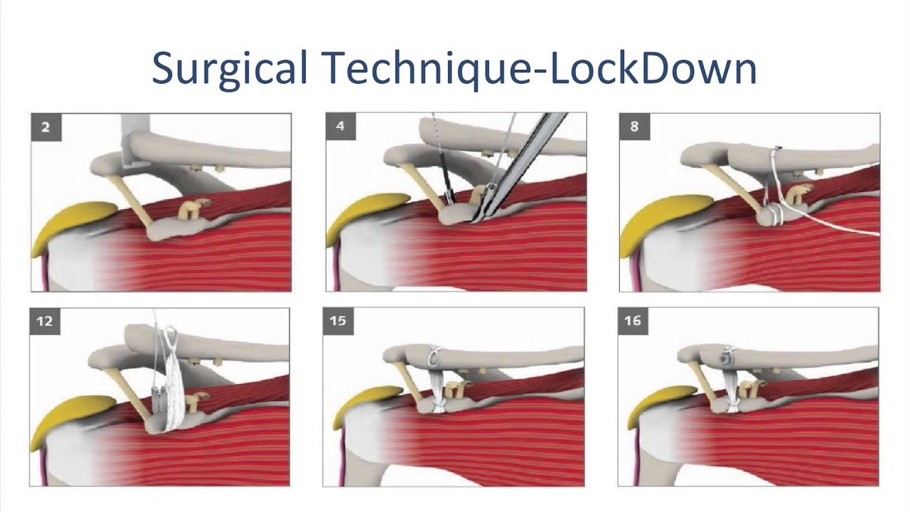 Prof Wallace Chronic ACJ reconstruction using braided polyester ...