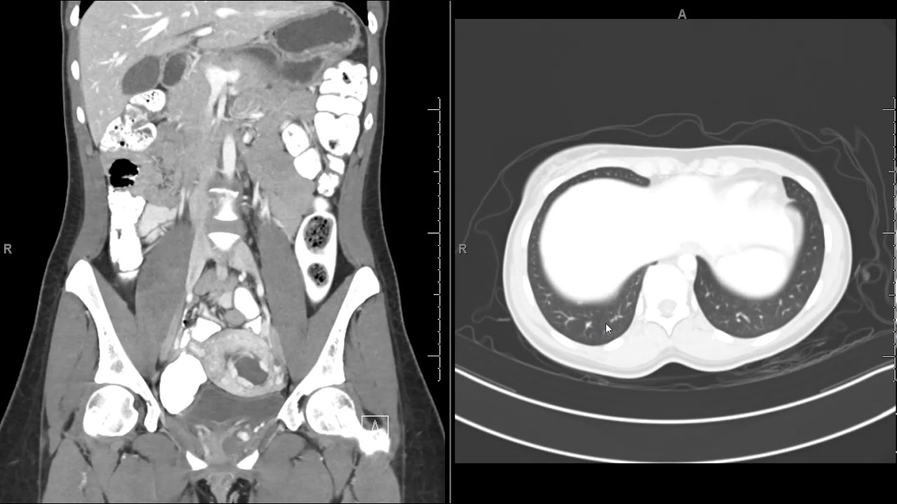 gestational trophoblastic neoplasm - YouTube