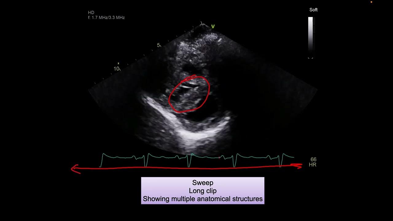 Knobology and image optimisation for focused echo - YouTube