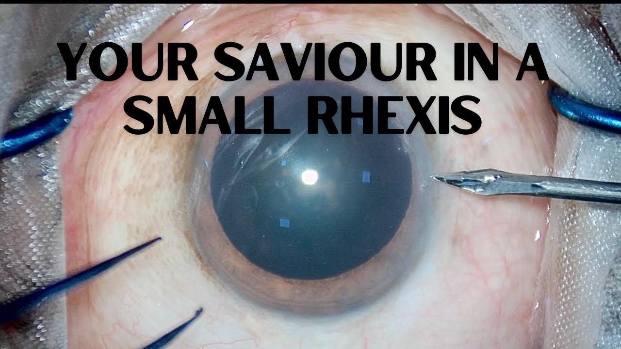Your saviour in a Small Rhexis | Cataract surgery - YouTube