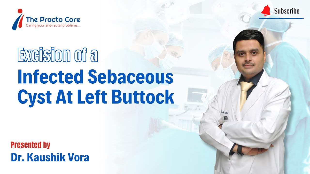 Excision of a Infected Sebaceous Cyst at Left Buttock | Dr. Kaushik ...