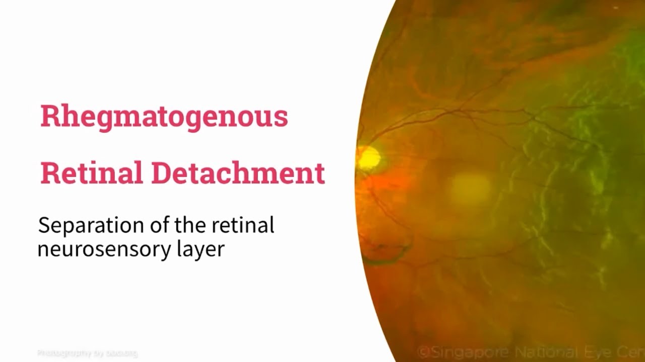 RHEGMATOGENOUS RETINAL DETACHMENT - YouTube