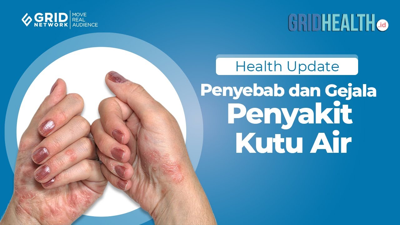 Wajib Tahu! Ini Penyebab dan Gejala Penyakit Kutu Air - YouTube