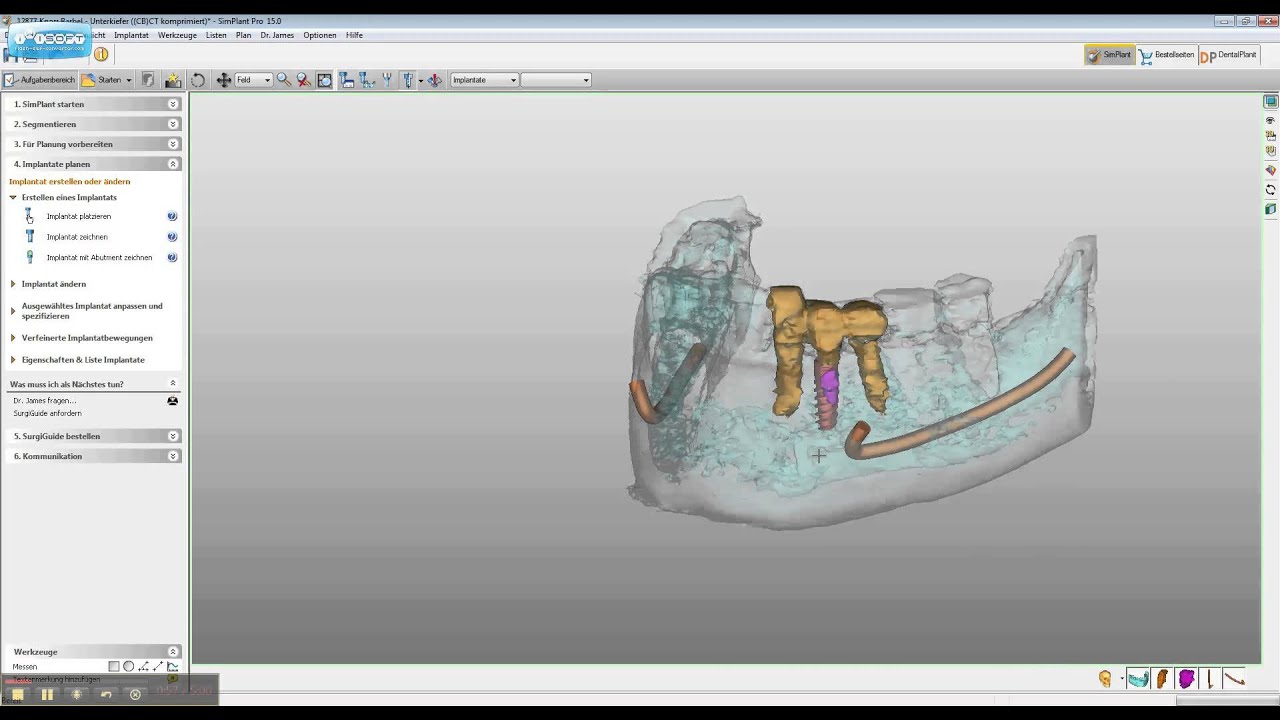 2014 02 13 12877 1 - Simplant Dental Software - YouTube
