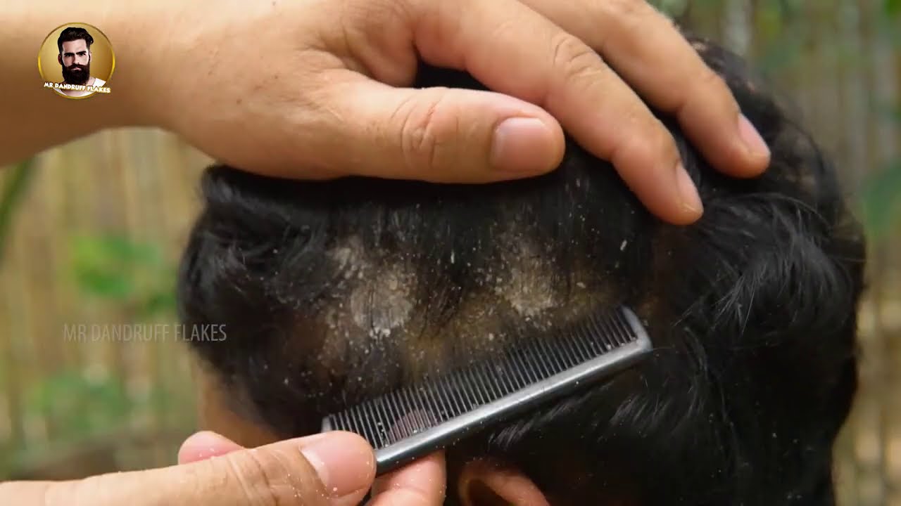 Dandruff Removal and Picking #29 - YouTube