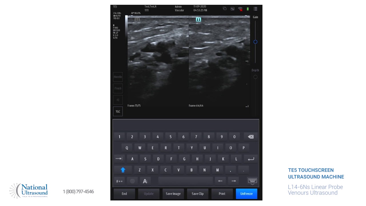 Mindray TE5 Ultrasound Machine Veinous Ultrasound Video Training ...