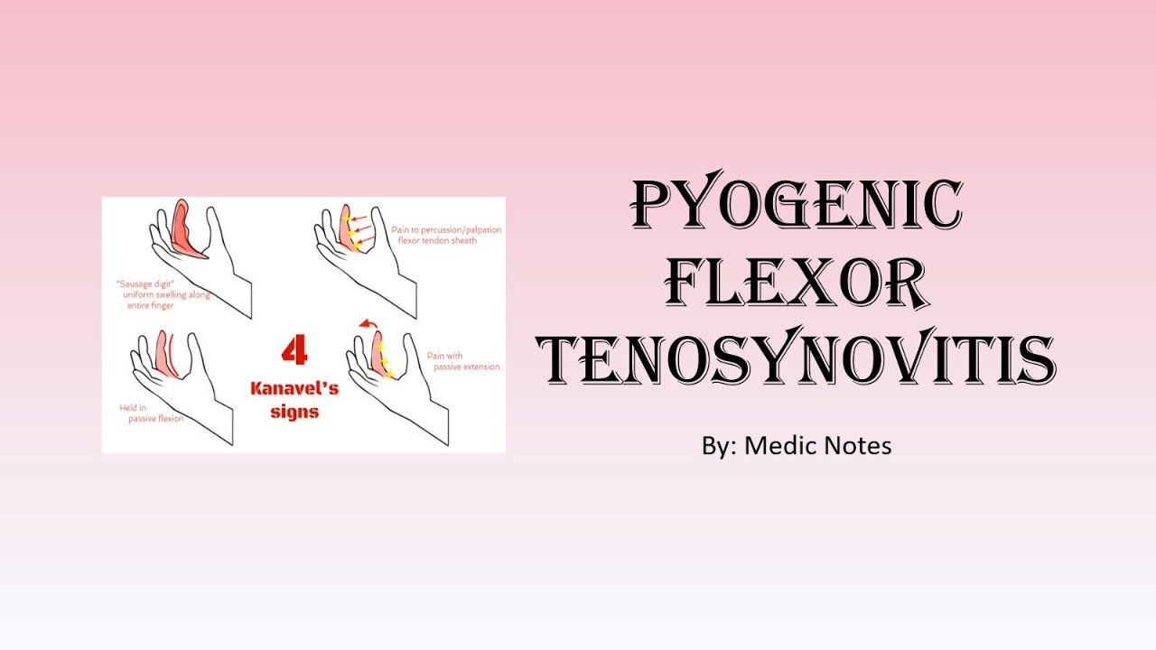 Pyogenic flexor tenosynovitis - epidemiology, causes, Kanavel signs ...