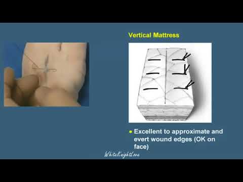 7 2 Vertical Mattress Suture Techniques Essential Surgical Skills ...
