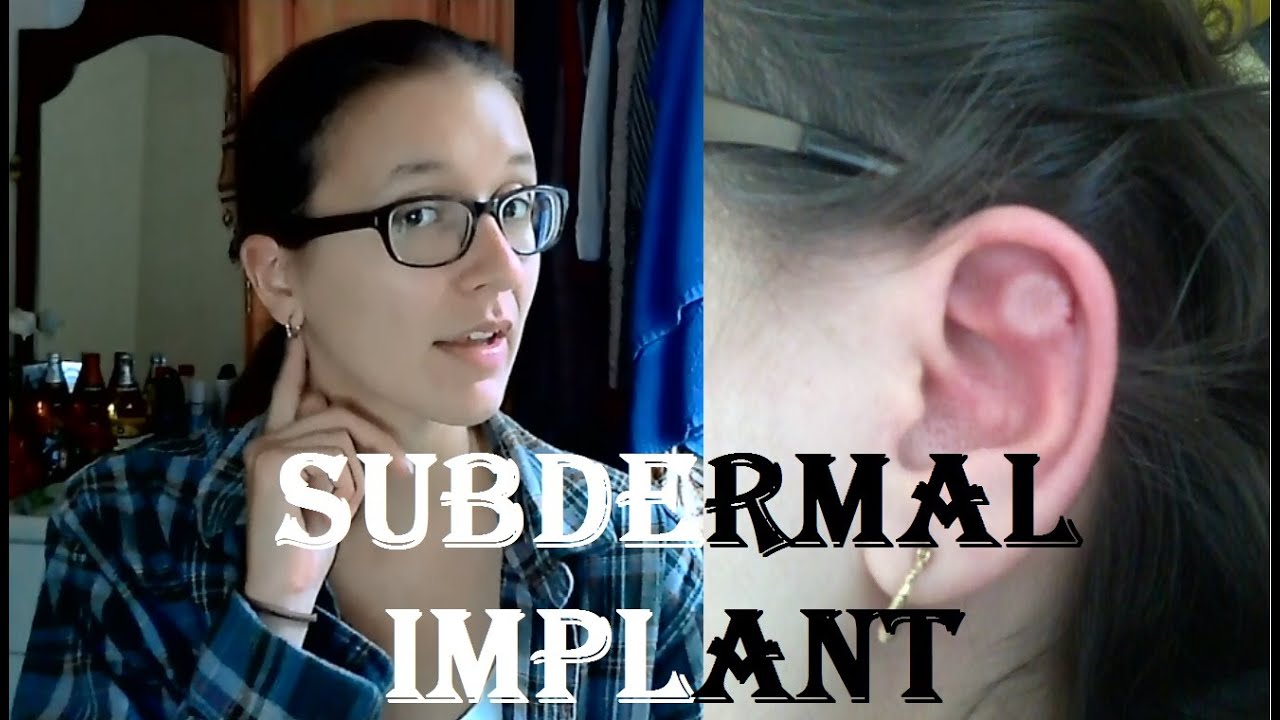 All about my SUBDERMAL IMPLANT in my EAR - YouTube