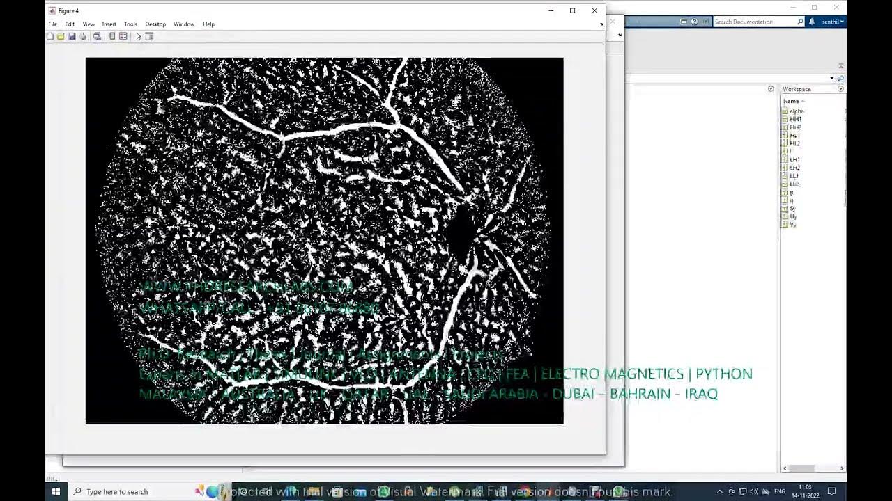 Diabetic Retinopathy SVM Microaneurysms and Hemorrhages Optic disc ...
