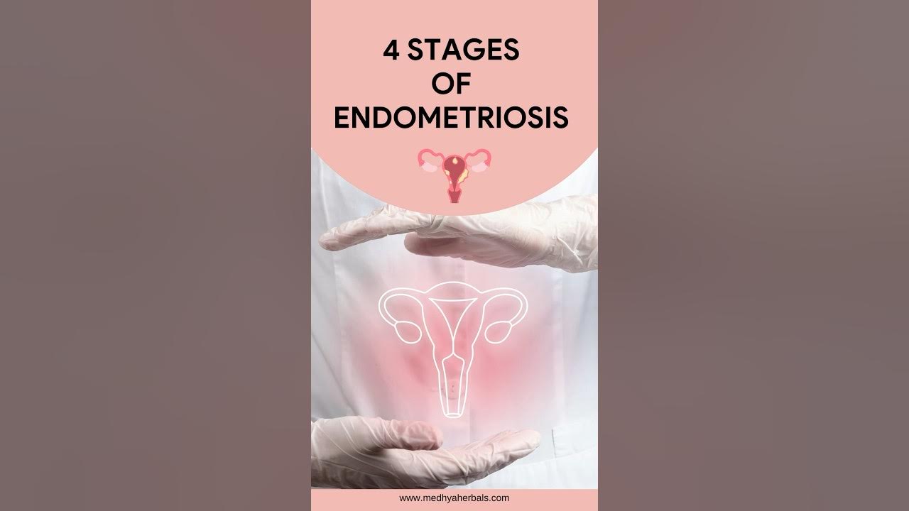 4 Stages of Endometriosis: Symptoms - YouTube