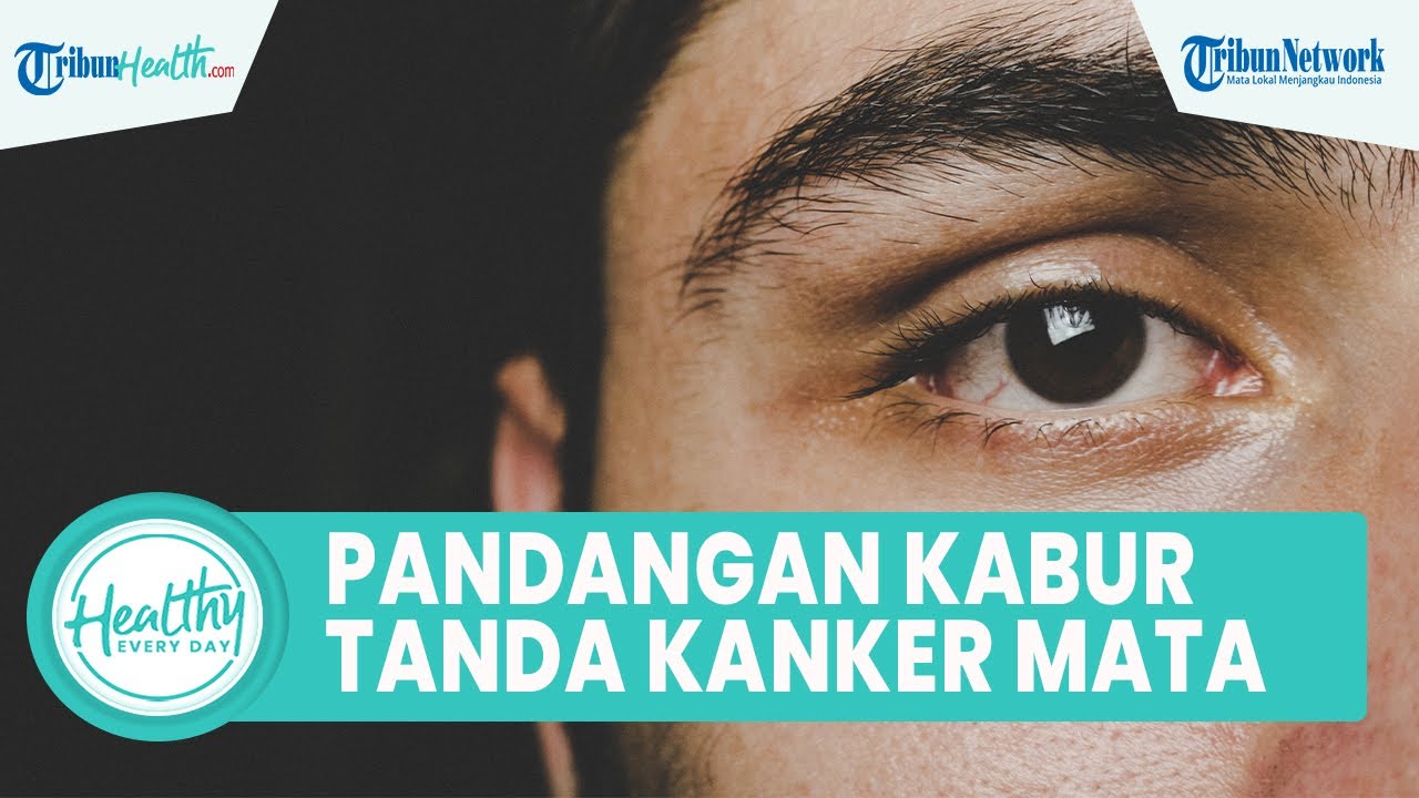 Waspadai Pandangan Kabur Bisa Jadi Awal Gejala Kanker Mata, Termasuk ...