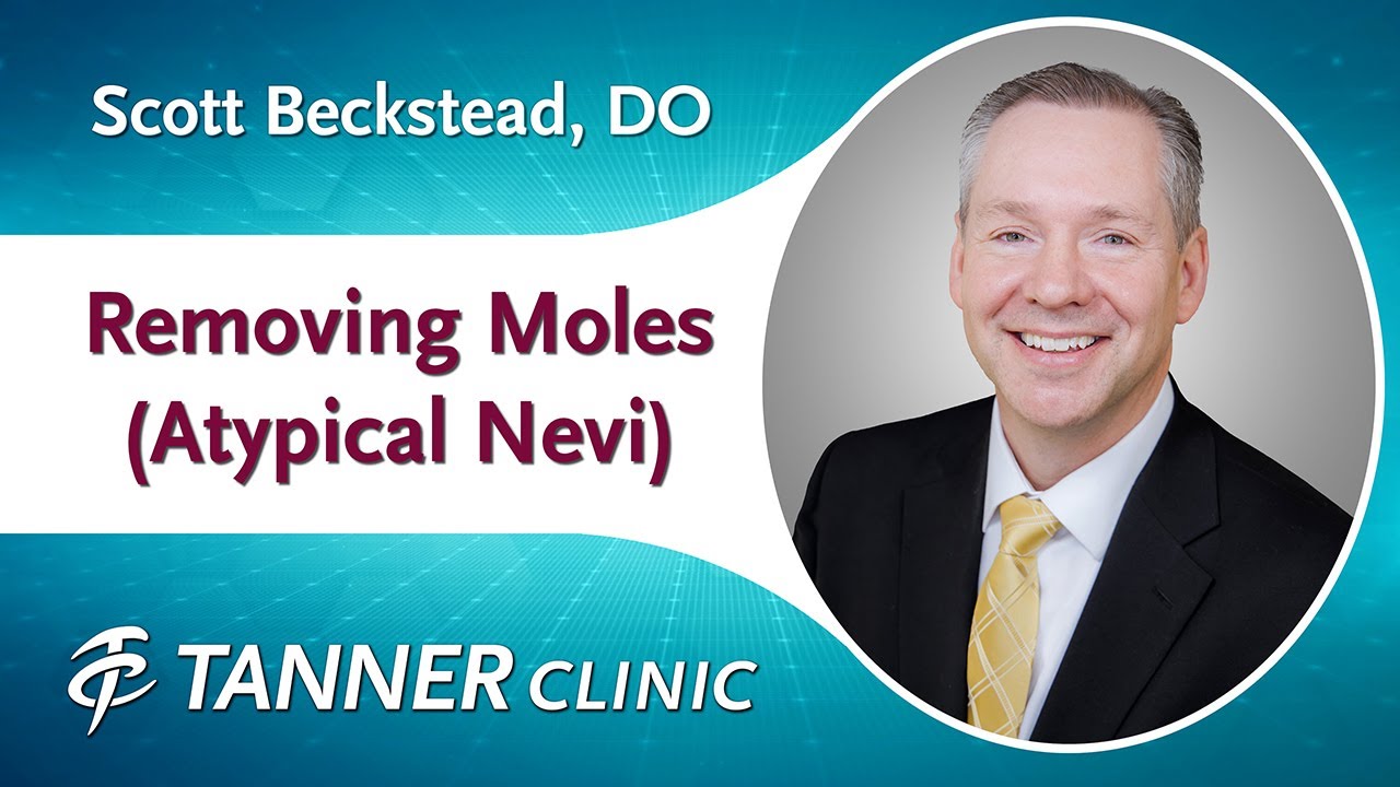 Removing Moles (Atypical Nevi) with Scott Beckstead, DO at our ...