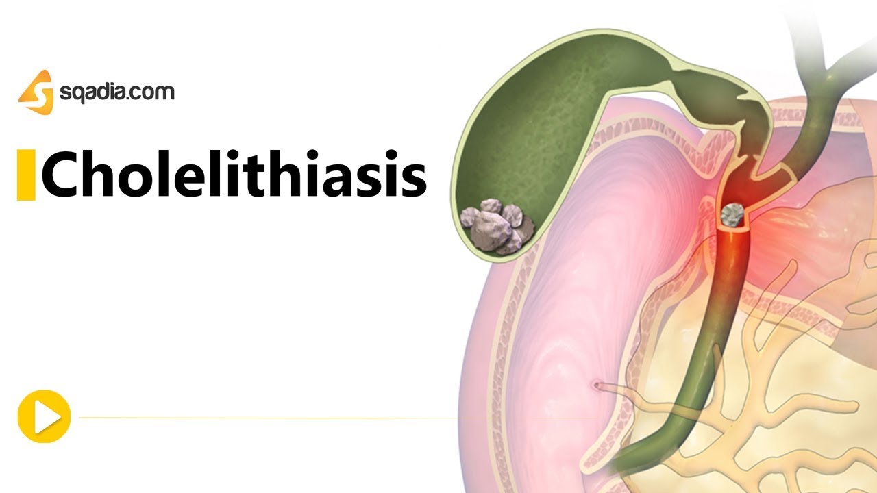 Cholelithiasis II Gastroenterology Medicine Animation Medical V Cholelithiasis II Gastroenterology Medicine Animation Medical V