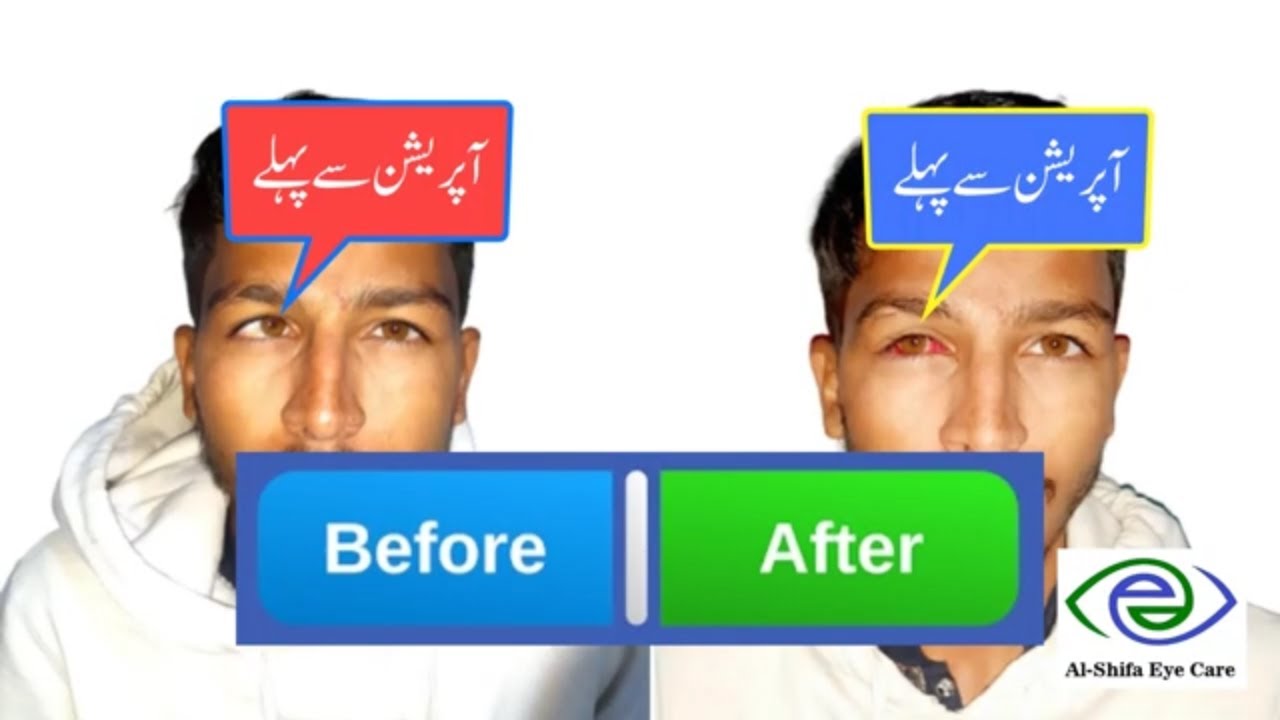 Squint (Bhengapan) Eye 25-Degree Correction Surgery Detail | Urdu/Hindi ...