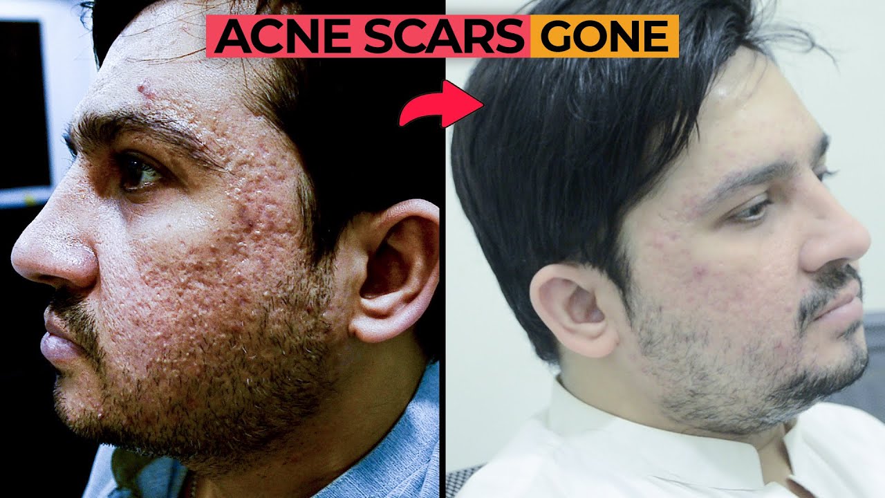 SEVERE ACNE SCARS - 2 SESSIONS OF ADVANCE FACE PRP RESULTS - YouTube