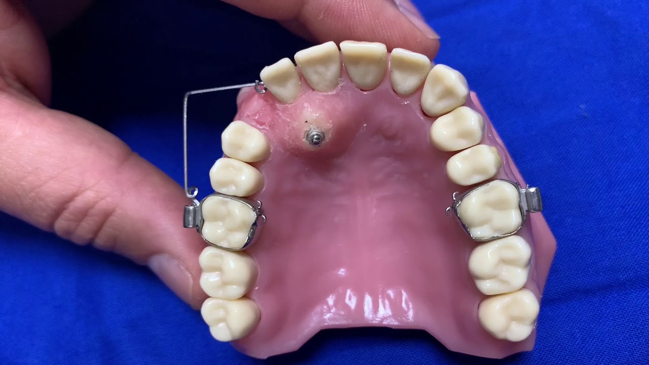 Treatment concept by Watted for a controlled alignment of palatally ...