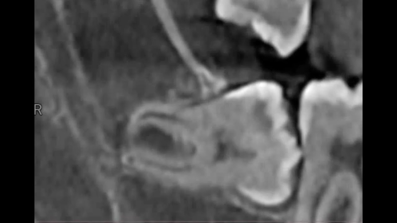 Removal of lingually displaced tooth root - YouTube