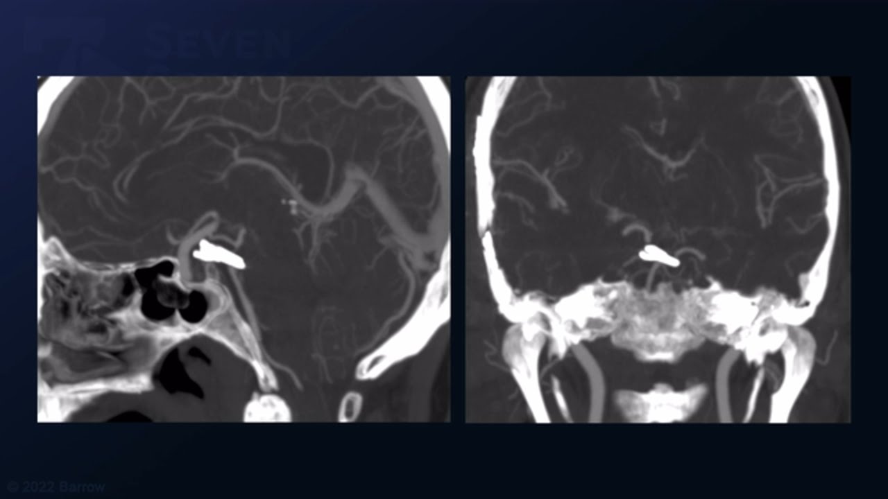 Orbitozygomatic Craniotomy with Posterior Clinoidectomy for Basilar ...