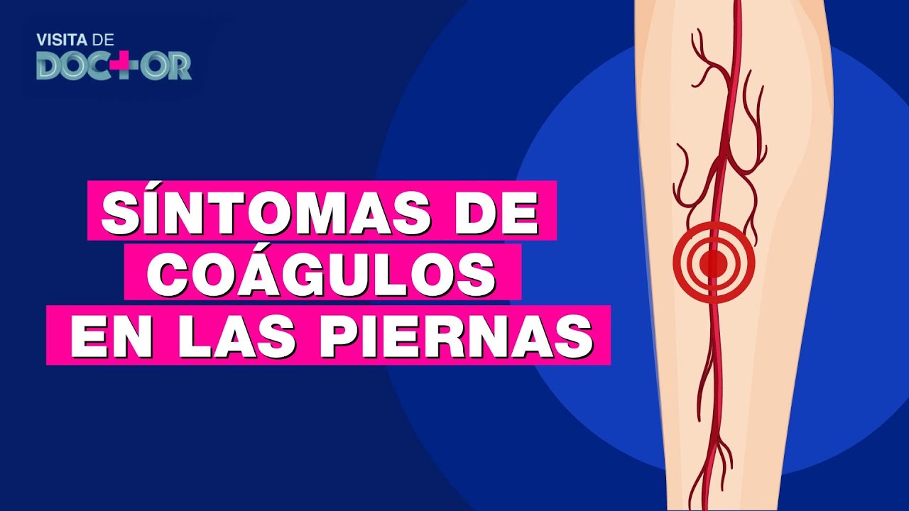 Trombosis venosa profunda: ¿Cómo identificarla? | Visita de Doctor ...