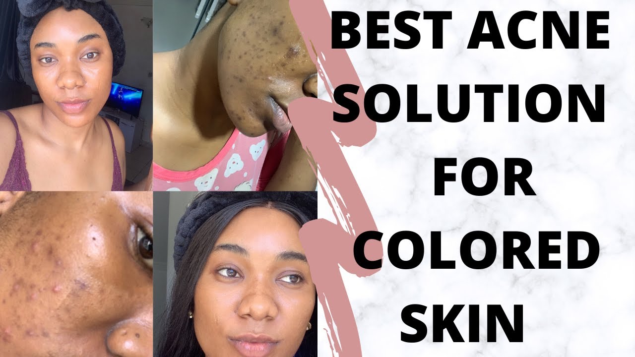 BEST ACNE SOLUTION FOR COLORED SKIN - YouTube