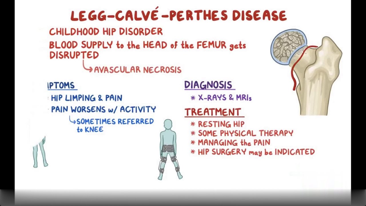 Legg Calve Perthes Disease Causes Symptoms Diagnosis Treatment Legg Calve Perthes Disease Causes Symptoms Diagnosis Treatment