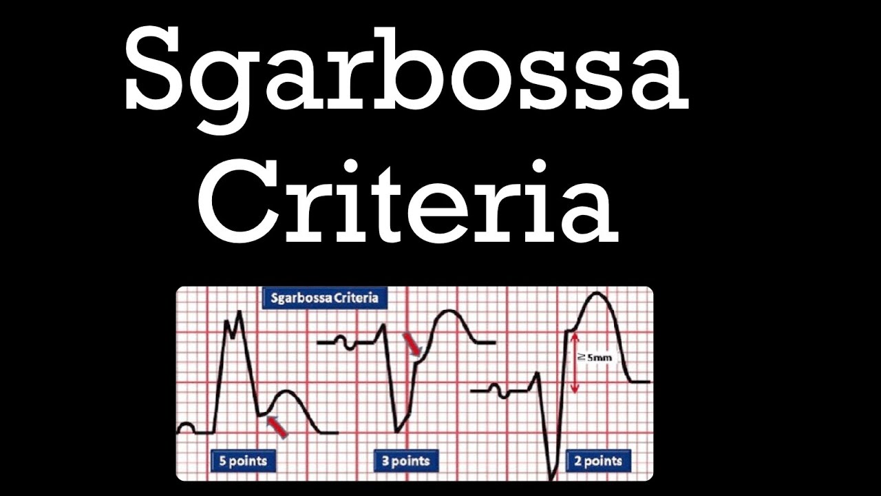 Modified Sgarbossa Criteria ( ECG ) - YouTube