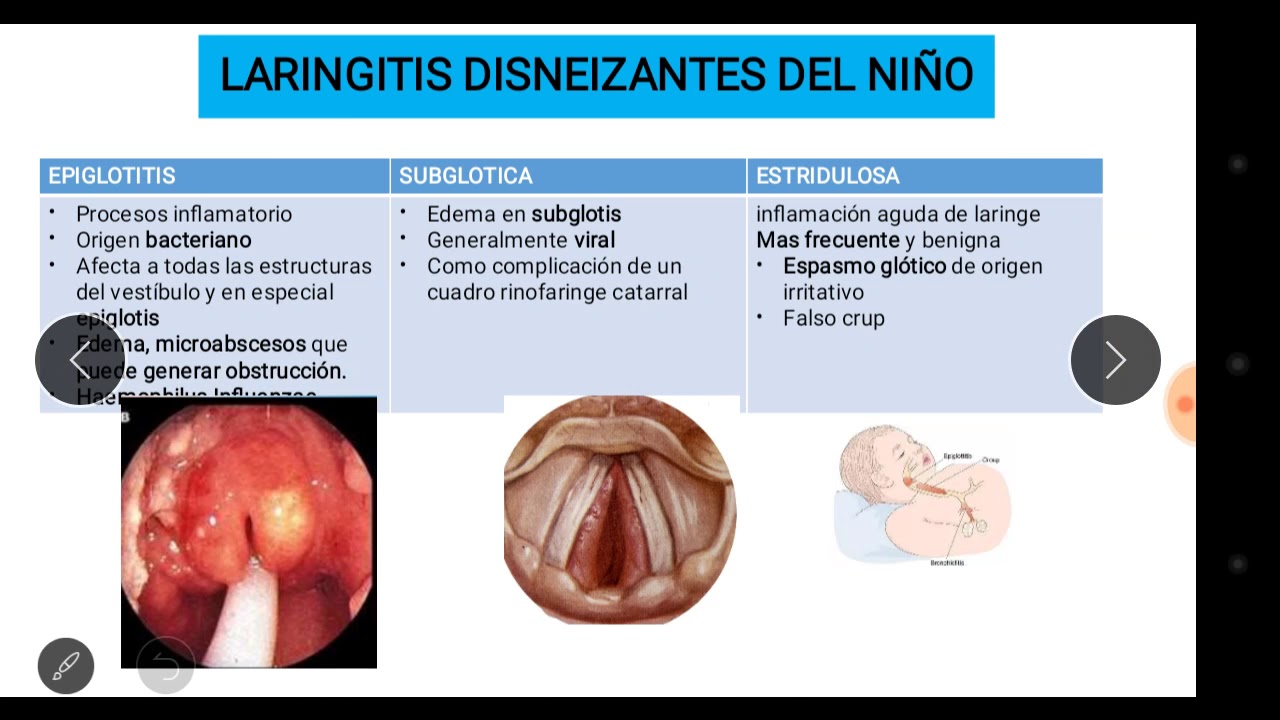 Patologia de laringe #medicina - YouTube