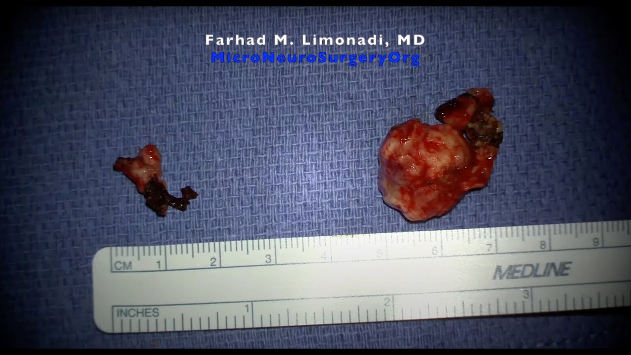 Surgery for resection of two brain tumors originating from kidney ...