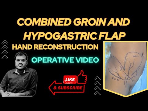 COMBINED GROIN AND HYPOGASTRIC FLAP FOR HAND RECONSTRUCTION - YouTube
