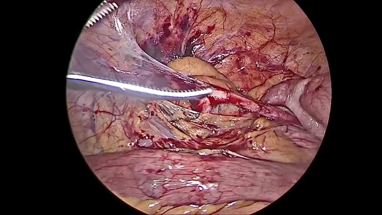 Laparoscopic Complete Mesocolic Excision and Central Vascular Ligation Right Colon Cancer Ali ...