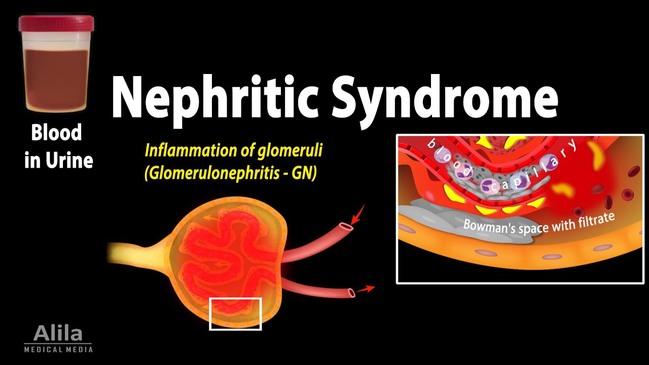 Nephritic Syndrome: Symptoms, Pathophysiology, Causes, Diagnosis and ...