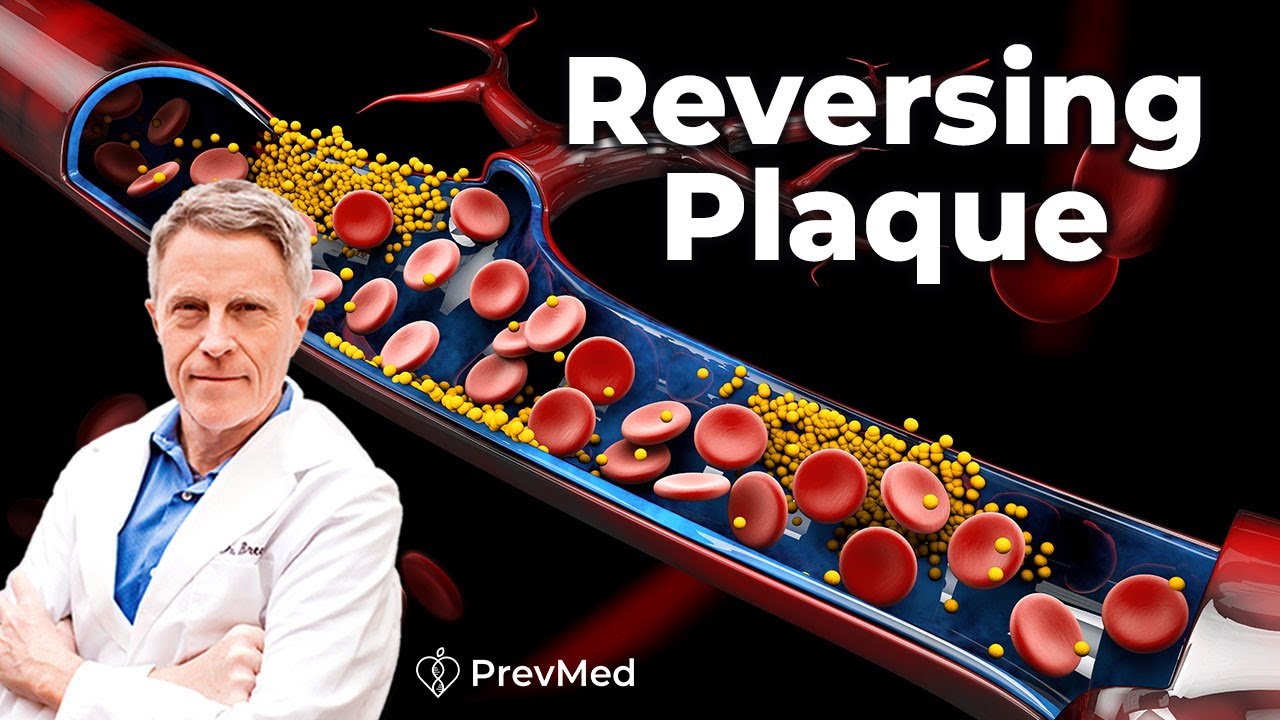 Plaque Reversal from a Patient's Experience - YouTube