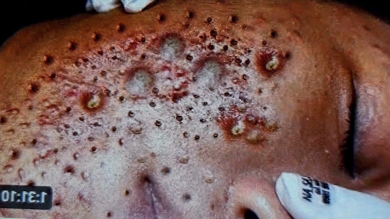 Watch This Giant Blackhead Get Popped!#011 - YouTube