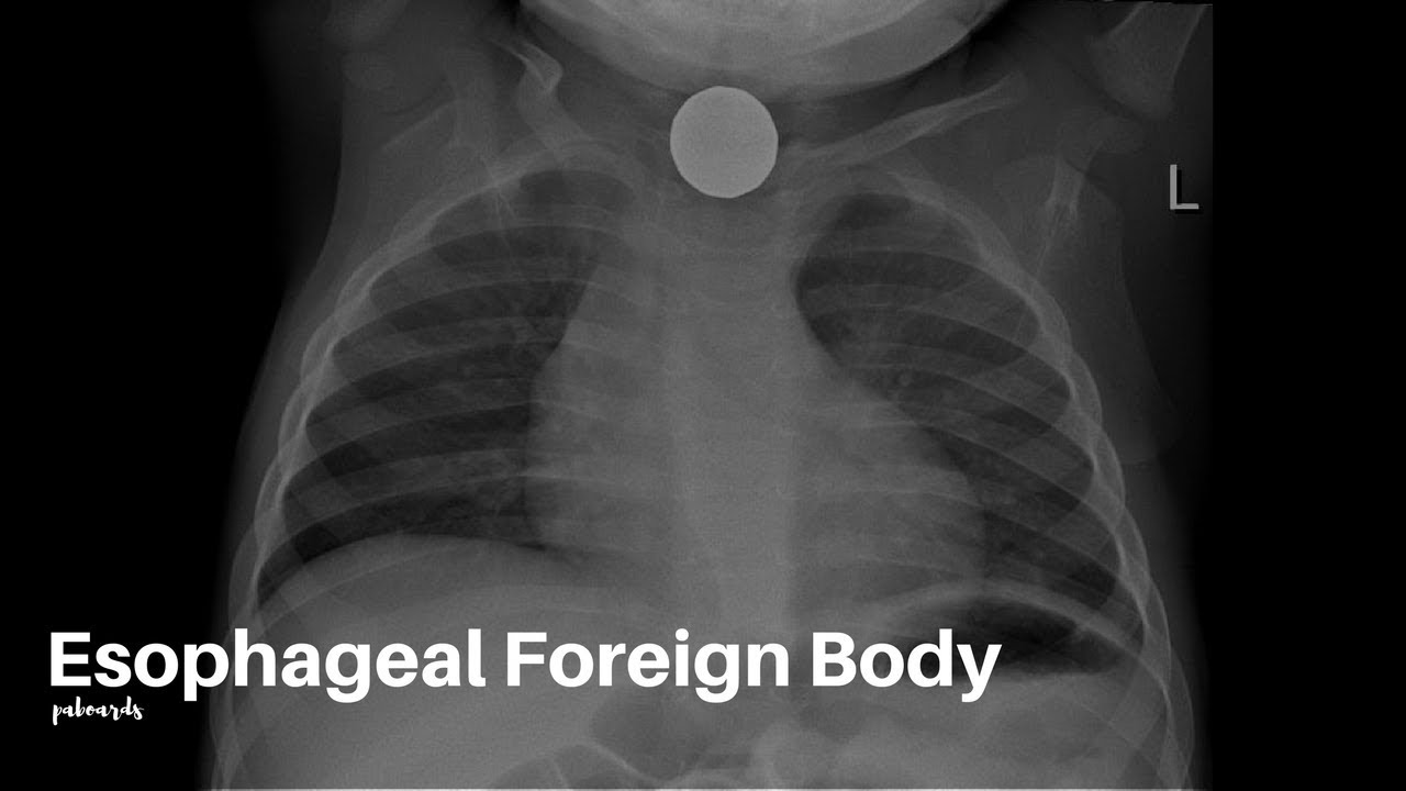 Esophageal Foreign Body: Ingestion vs Impaction - YouTube