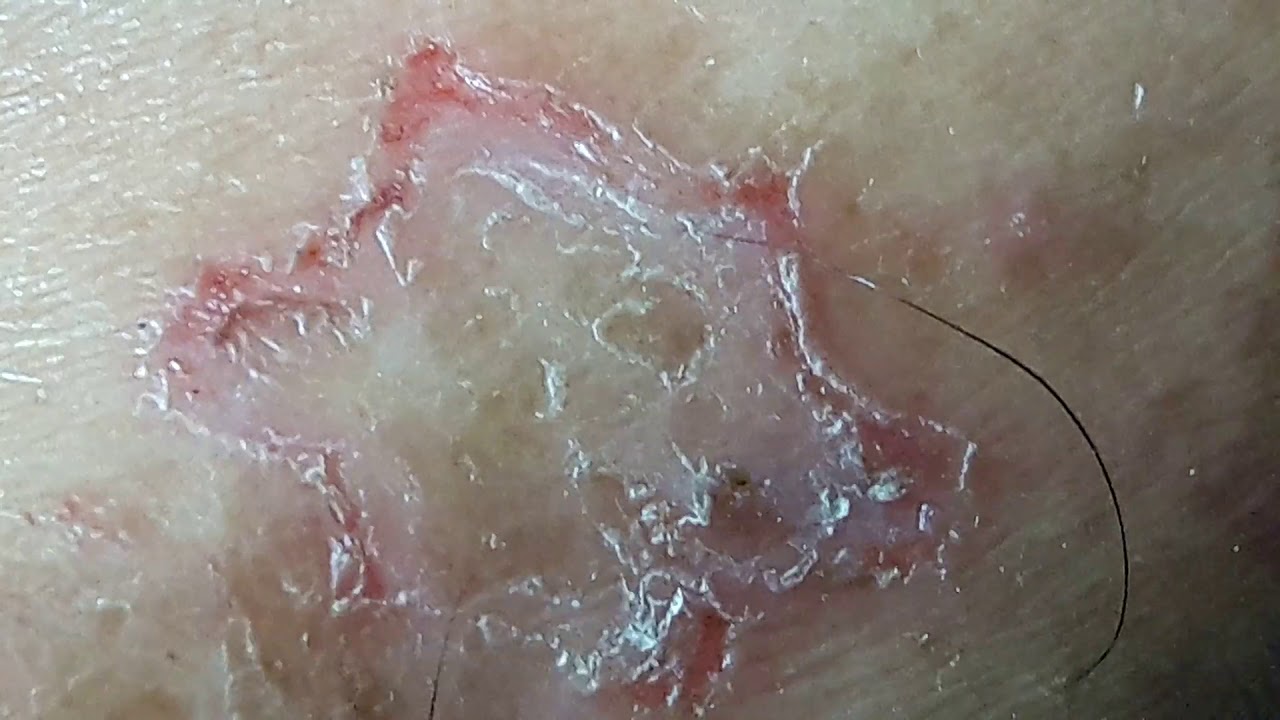 Tinea Corporis' twin Tinea Versicolor on back - YouTube