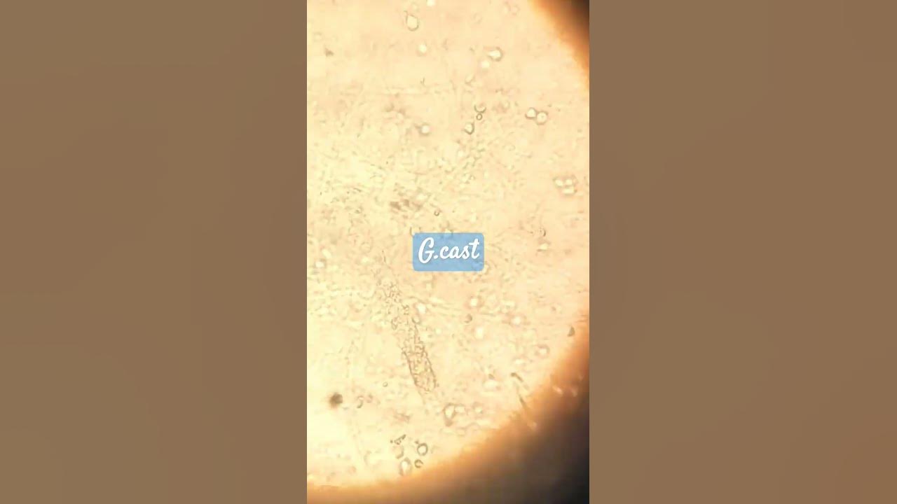 Urine Analysis Granular Cast Urine Microscopy Cast In Urine Youtube