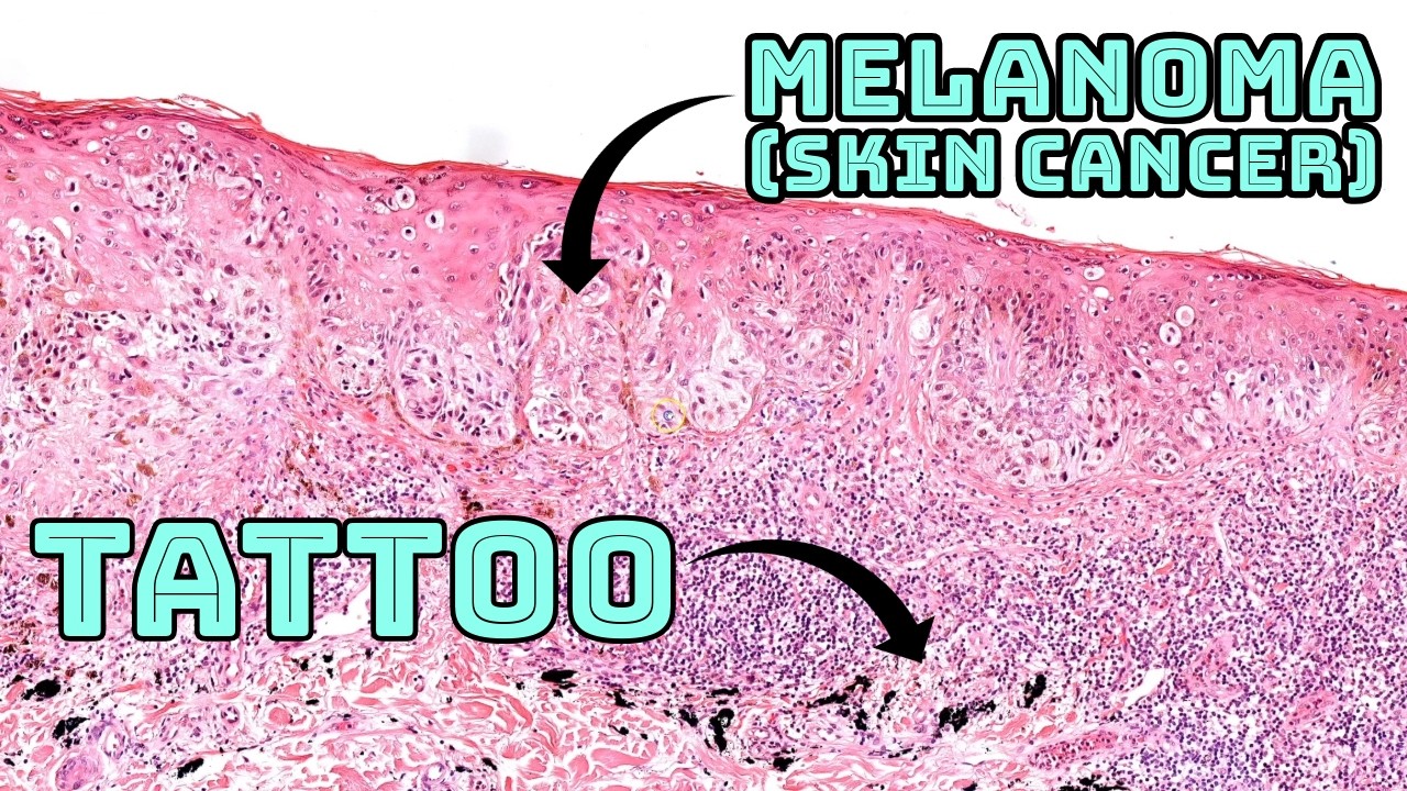 Melanoma skin cancer in tattoo under the microscope (coincidence ...