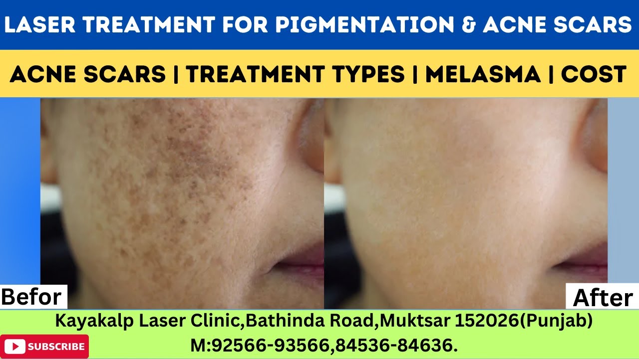 Laser Treatment for Pigmentation & Acne Scars | Acne Scars | Treatment ...