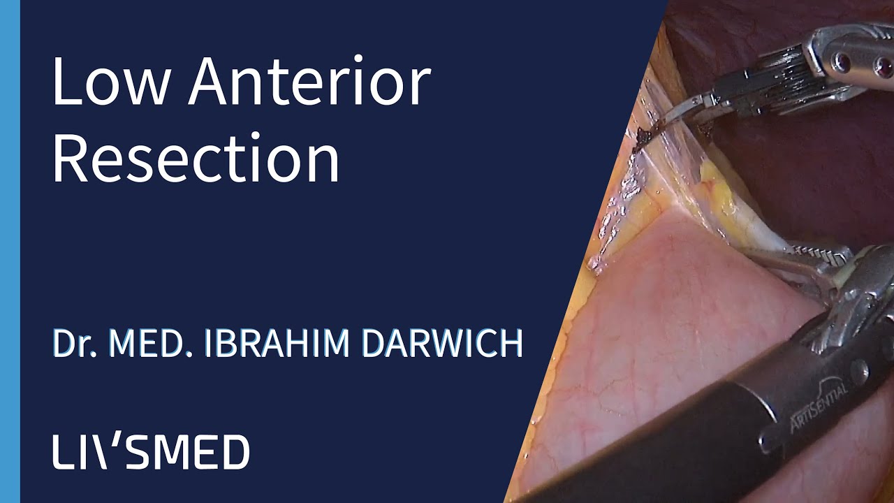Low Anterior Resection - Dr. Ibrahim Darwich - YouTube