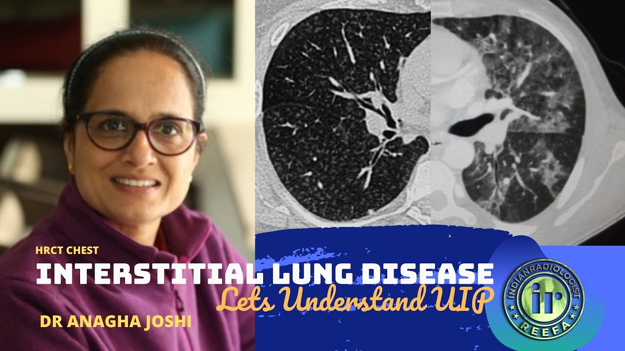 HRCT INTERSTITIAL LUNG DISEASE | UIP | ANAGHA JOSHI | CT VIDEO TUTORIAL ...